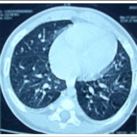 Cxr On Admission Bilateral Pulmonary Inflammatory Lesion With Enlarged