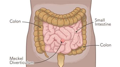 Meckels Diverticulum Symptoms Risks And Treatments Los Angeles Times