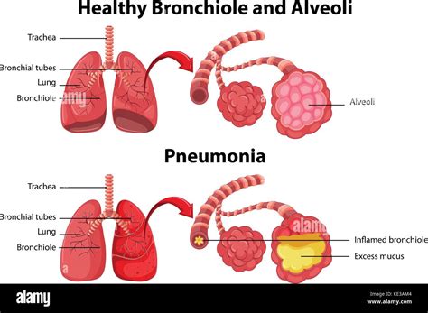 Healthy And Unhealthy Lungs Hi Res Stock Photography And Images Alamy