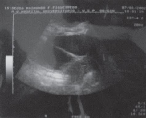 Endoscopic Treatment Of Vesical And Urethral Perforations After Tension Free Vaginal Tape Tvt