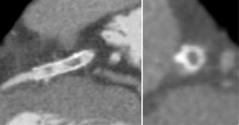 cad rads 4a s in stent stenosis of the proximal lad with significant