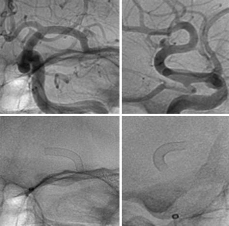 Rescue Thrombectomy In Post Procedural Fd Thrombosis