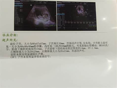 怀孕10周胎儿彩超图片 孕10周宝宝b超图片 伤感说说吧