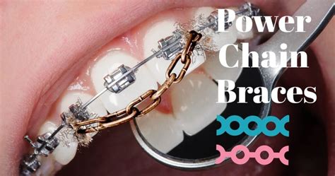 Power Chain Braces Ultimate Guide Toothcareusa Com