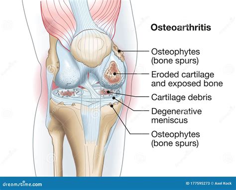 Osteoarthritis Knee Phenotypes Cartoon Vector