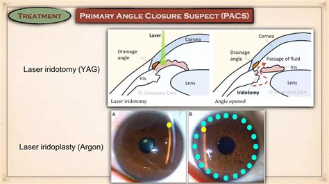Primary Angle Closure Glaucoma Ppt Free Download