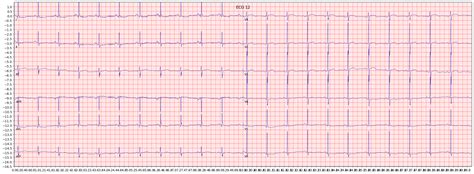 Examples Of Ischemic In Anterolateral Leads Iscal Ecg Library