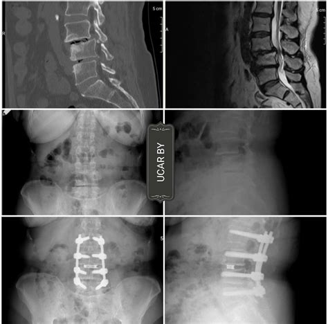 Unstable Degenerative Spine Prof Dr Bekir Yavuz UÇar