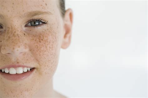 What Are The Treatments For Skin Discoloration Healthfully
