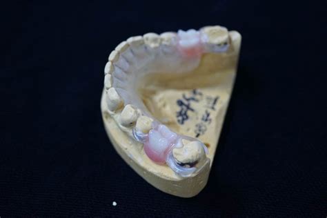 China Customized Partial Acrylic Denture With Clear Frame Manufacturers