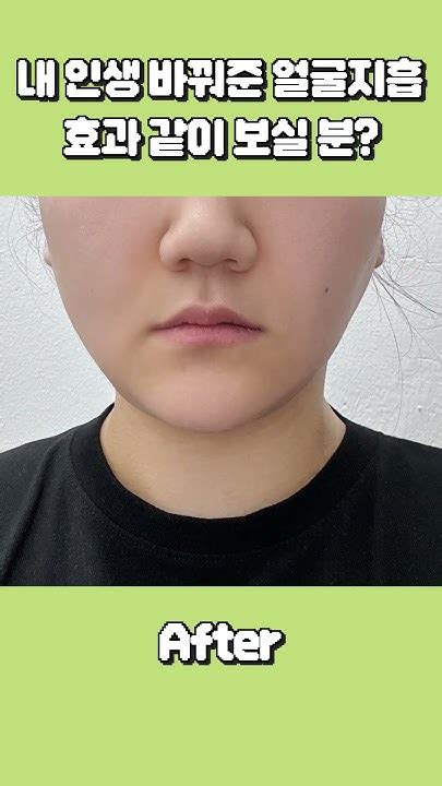 내 인생 바꿔줄 얼굴지흡 효과 같이 보실 분 지흡 지흡후기 지방흡입후기 얼굴지흡 지방흡입 얼굴지방흡입 이중턱