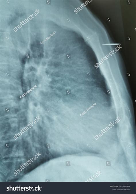 Chest X Ray For Foreign Body At Darcy Simoi Blog