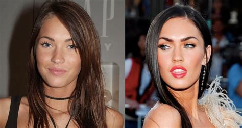 Hemosiderin Staining Causes Risks And Treatment