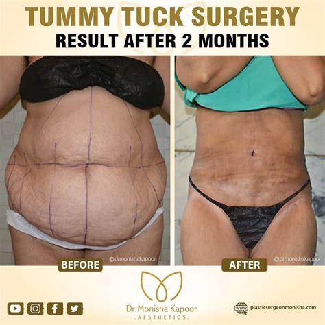 Best 12 Tummy Tuck Abdominoplasty Artofit