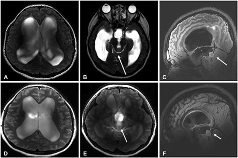 Comparison Of 3 And 7 Tesla Magnetic Resonance Imaging Of Obstructive