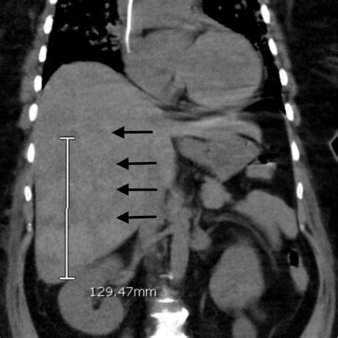 Non Contrast Ct Scan Of The Abdomen And Pelvis Showing Heterogeneous