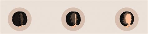 Oral Spironolactone For Female Hair Loss Regain Your Confidence