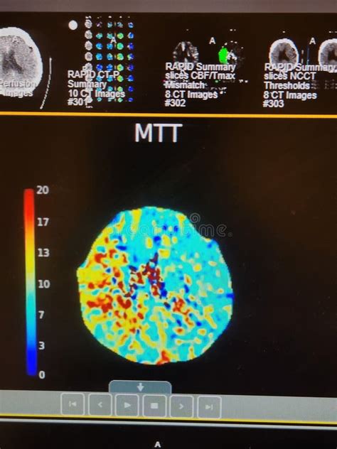 Brain Perfusion Scan Right Middle Cerebral Artery Occlusion Stock