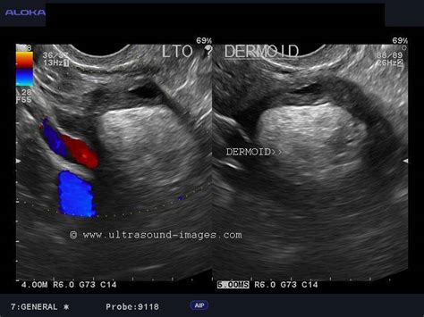 Dermoid Ovarian Cyst Ultrasound