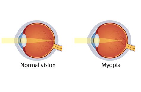 How To Choose A Myopia Control Treatment Foresee Eyecare