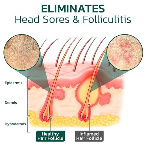 Scalp Folliculitis Hair Loss