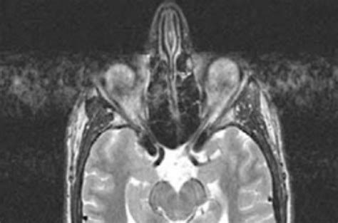 Motion Artifact Direction Questions And Answers In MRI