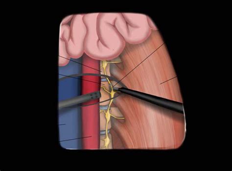 And 8 Left Retroperitoneal Cavity Aorta Displaced To The Left Rigth Download Scientific