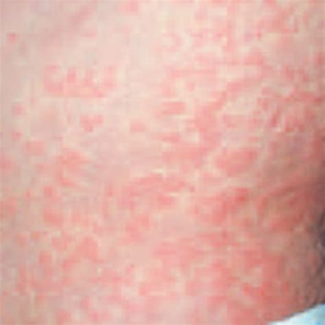 Typical Maculopapular Rash On The Flank Of A Patient With Caps Printed