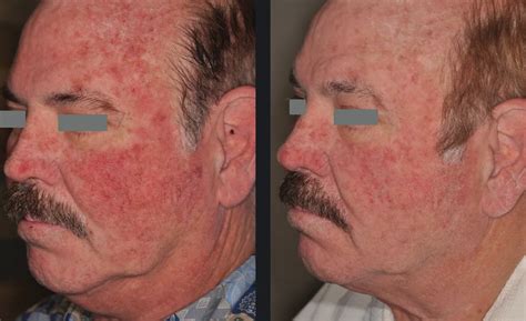 Patient Laser And Ipl Treatments For Vascular Lesions Candela Medical