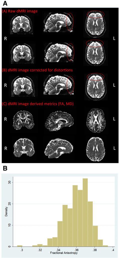 Diffusion Mri Analysis Pipeline And Initial Results For Fractional Download Scientific