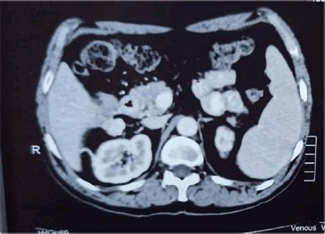 Ct Abdomen Showing Encapsulated Mass Arising From 2nd Part Of Duodenum