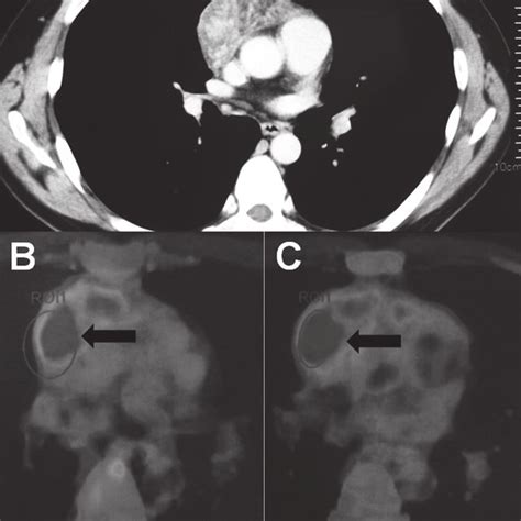 A Chest Computed Tomographic Ct Scan Showing Anterior Mediastinal