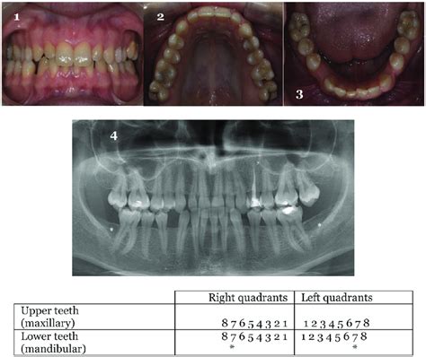 Tooth Agenesis In A Non Syndromic 21 Year Old Female Patient Intraoral