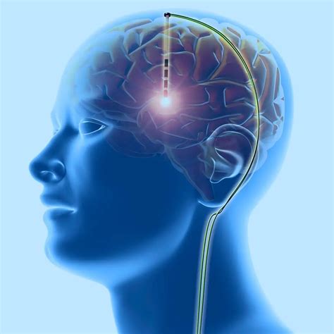 Deep Brain Stimulation Dbs Surgery Atlas University Hospital İstanbul