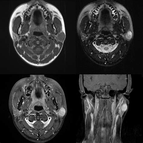 Pediatric Pleomorphic Adenoma Pediatric Radiology Reference Article