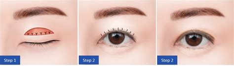 Ptosis Causes Treatment And More Dream Plastic Surgery