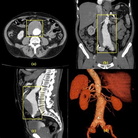 Pdf Abdominal Aortic Aneurysm Segmentation From Ct Images Using