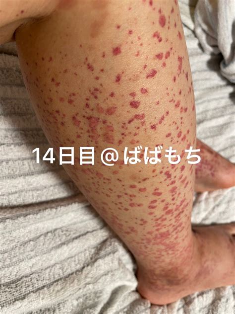 Iga血管炎14日目～皮膚症状悪化、プレドニン増量、そしてカビカレー～ 大人のiga血管炎～ゆるゆる闘病ブログ