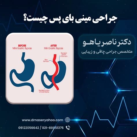 هر انچه که باید درباره جراحی مینی بای پس بدانید