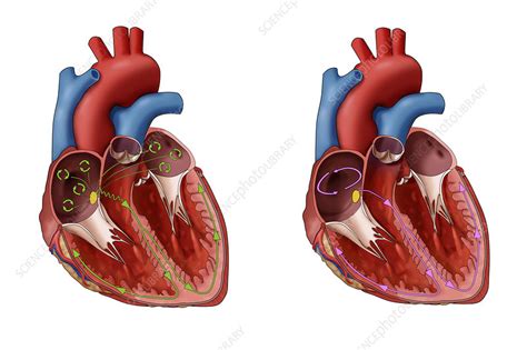 Atrial Fibrillation And Flutter Illustration Stock Image C Science Photo Library