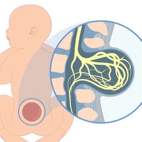 اسپینا بیفیدا مرکز تصویربرداری پزشکی دکتر قائمیان