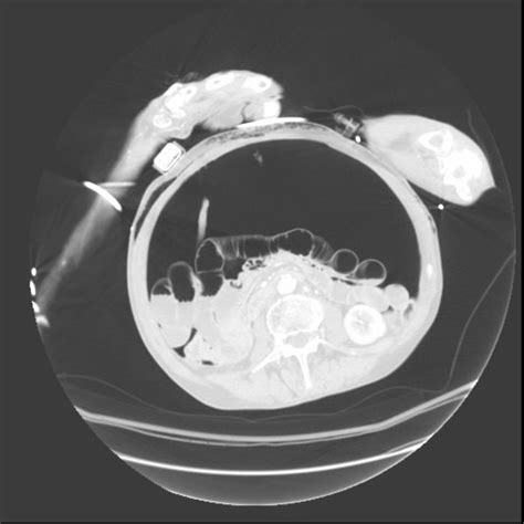 Pdf Emergency Percutaneous Needle Decompression For Tension