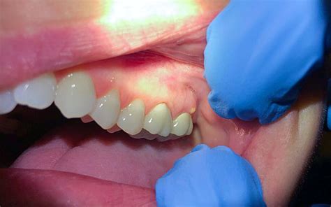 Dental Abscesses Symptoms Causes And Treatments Guide