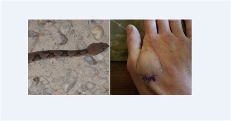 Copperhead Bite