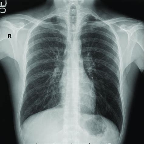 Chest X Ray Of Case 1 Her Chest X Ray Was Showing Bilateral Nodular Download Scientific