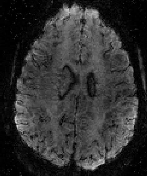 2019 Minnesota Workshop On Cortical Depth Resolved Fmri Methods Layer Fmri Blog