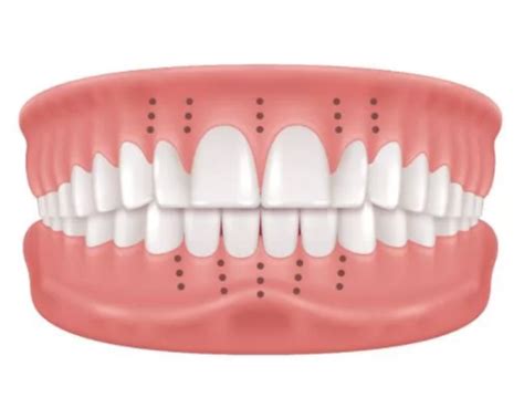 Intermaxillary Elastics With Clear Aligners Types And Use