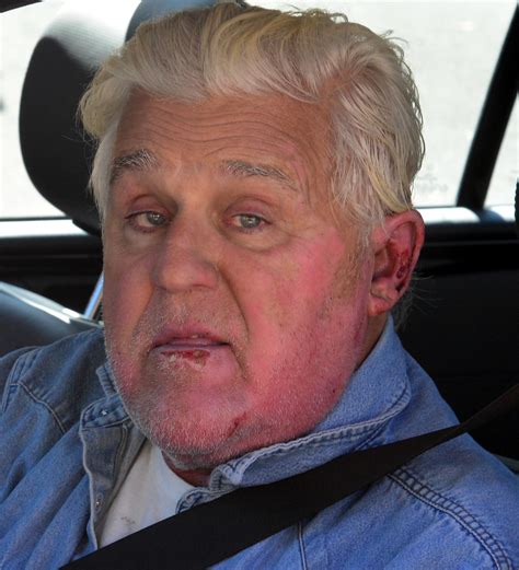 Jay Leno Has Brand New Ear After Car Motorcycle Accidents