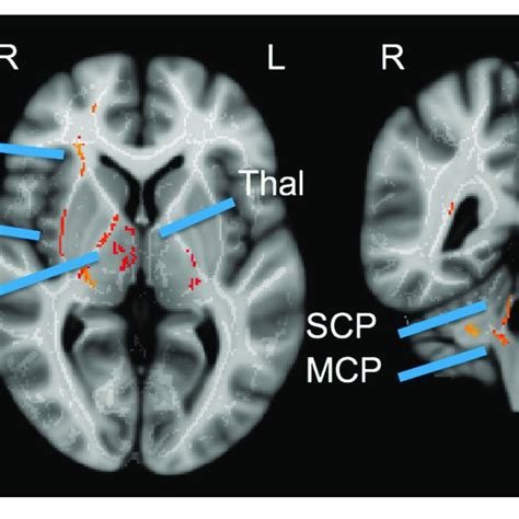 Cross Sectional Voxel Wise Comparison Control Patient Axial
