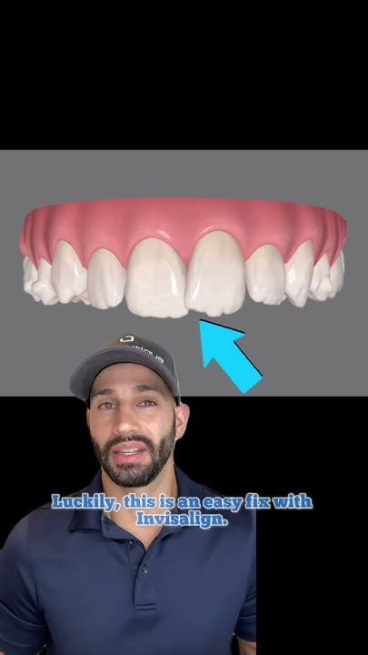Invisalign Treatment To Straighten Overlapped And Crooked Front Teeth